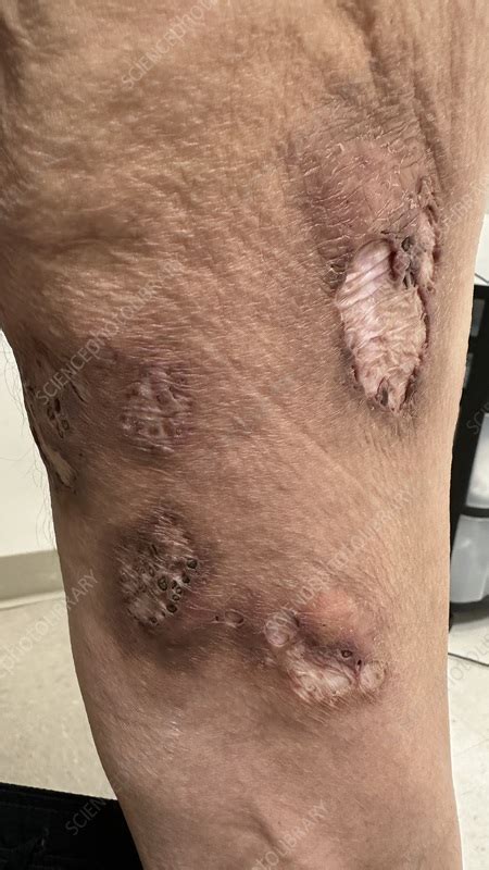 Pyoderma Gangrenosum Treated With Infliximab Stock Image C059 9151 Science Photo Library