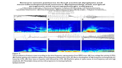Stereo Eeg Or Invasive Eeg In Surgical Epileptologypptx