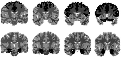 Sample Tissue Segmented Images With Segmented Gray Matter Within The