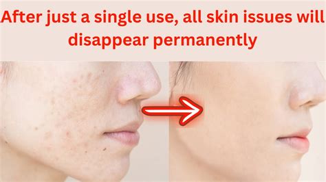 All Skin Issues Will Disappear Permanently Best DIY Facial And Exfoliating Treatment YouTube