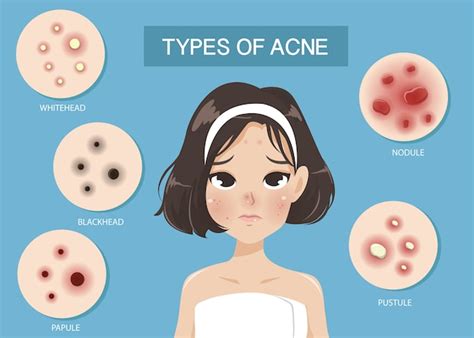 Premium Vector Types Of Acne