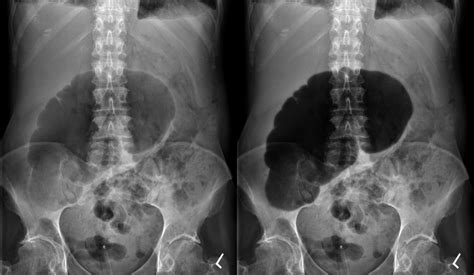 Cecal Volvulus Vs Sigmoid Volvulus