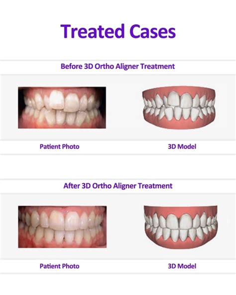 Digital Aligner буюу тунгалаг аппарат гэж юу вэ Индранил Дентал Менежмент ХХК