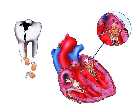 Endocarditis Archives British Heart Valve Society