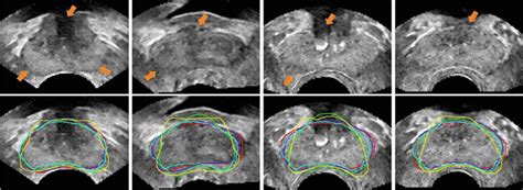 Visual Comparison Of Prostate Segmentation Results Top Row Prostate