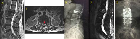 MRI Of L2 Compression Fracture With Posterior Vertebral Cortex Download Scientific Diagram