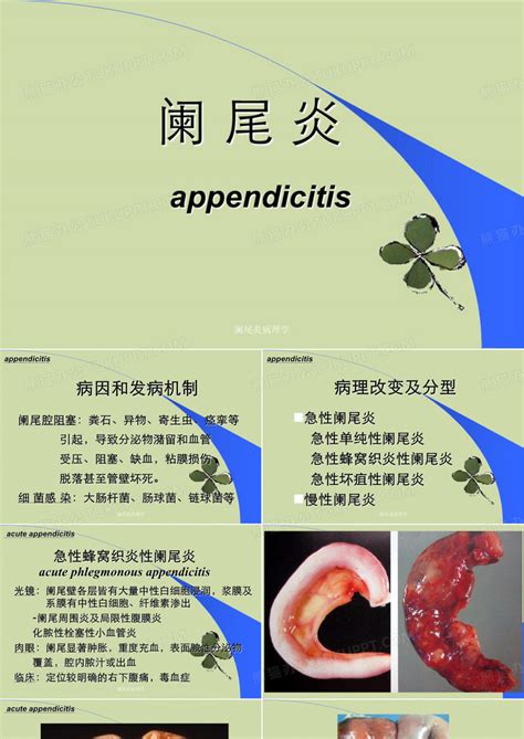 阑尾炎病理学PPT模板下载 编号qznnpkrg 熊猫办公