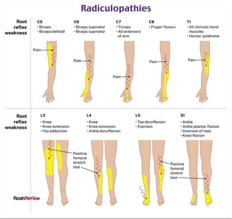 Radiculopathies A Visual Representation Of Nerve Root Involvement