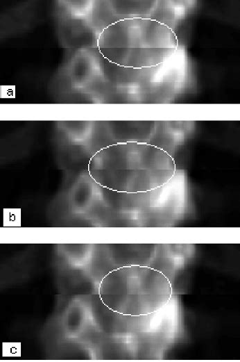 Joining Images Show The Alignment Of The Spinous Process Labeled D In