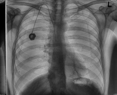 Single Exposure Dual Energy X Ray Imaging With Reveal 35c