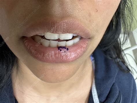 Mucocele Stock Image C060 7080 Science Photo Library