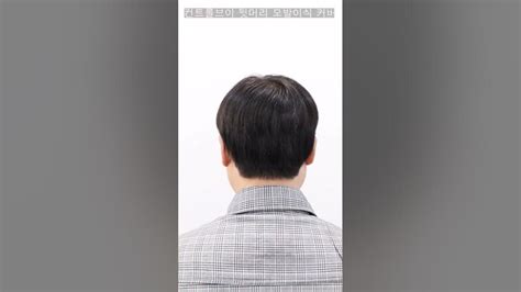 붙임머리 증모술이 아닌 후두부 커버전용제품으로 티나지않고 불편하지 않게 시술해드렸습니다 Shorts 모발이식 모발이식흉터