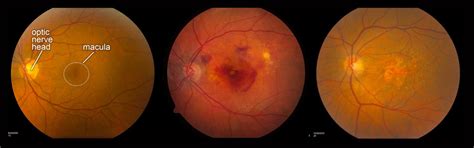 Story Of Discovery Nei Funded Research Paves Way For New Dry Amd Drugs National Eye Institute