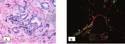 A Area Of Fibrosis Containing Islets Arrows Adjacent To The Ductal Download Scientific