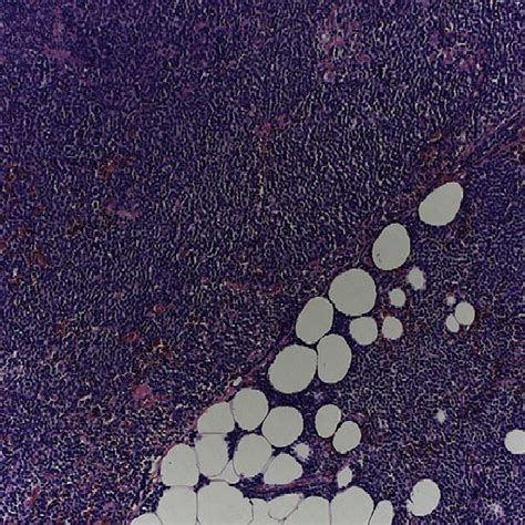 Thickened Appendix And Mesoappendix With Porcelain Like Suface Download Scientific Diagram