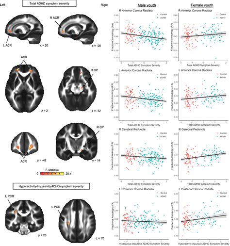 Attention‐deficit Hyperactivity Disorder And White Matter Microstructure The Importance Of