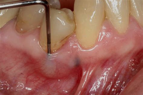 Visual Guide To Tooth Abscess Stages Pictures Symptoms And Treatment Chaztin