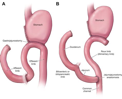 Billroth Ii Gastrojejunostomy Antrectomy Distal Gastrectomy