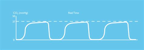 Capnography Waveform Interpretation Etco2 Basic S 56 Off