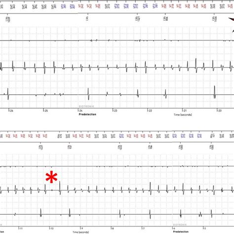 Intracardiac Electrogram From A Ventricular Arrhythmia In Abbott Case Download Scientific