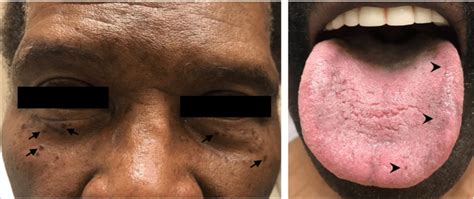 New Onset Hyperpigmented Macules Below The Eyes Arrows And Lateral