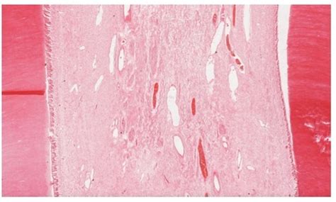 Classification And Histopathology Of Pulp Disease Flashcards Quizlet