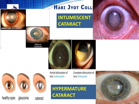 Intracapsular Cataract Extraction Pptx