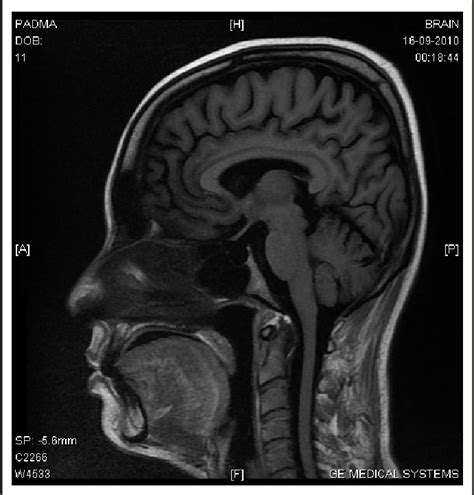 Mri Brain Showing Empty Sella Red Arrow In Our Patient Download Scientific Diagram