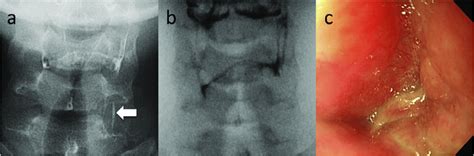 Videofluorographic And Endoscopic Findings Of The Pyriform Sinus In Download Scientific Diagram