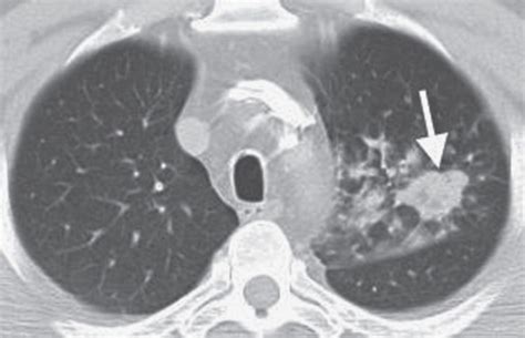 Solitary And Multiple Pulmonary Nodules Radiology Key