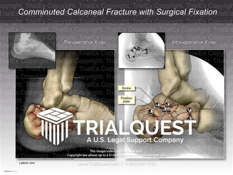 Comminuted Calcaneal Fracture With Surgical Fixation Trialquest