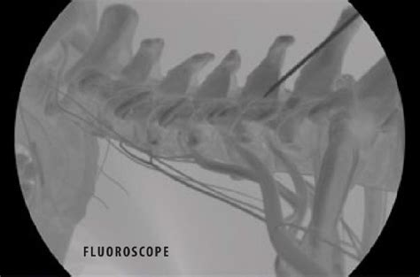 Cervical Facet Radiofrequency Neurotomy Spine And Orthopedic Center