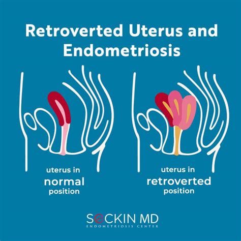 Retroverted Or Tilted Uterus And Endometriosis
