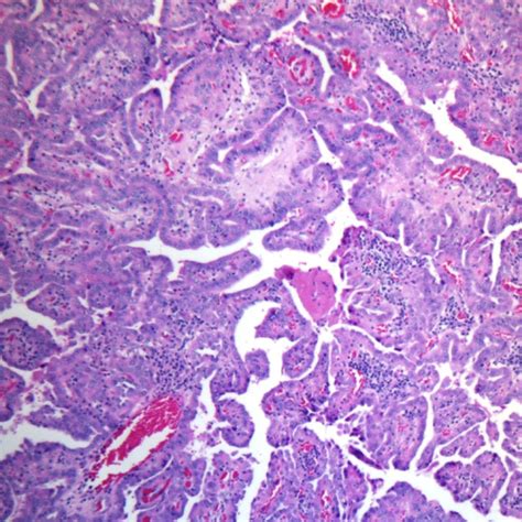 Histology Of The Thyroid Nodule Typical Thyroid Papillary Carcinoma Download Scientific