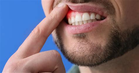 Gingivectomy Procedure Risks And Benefits Zenit Dent