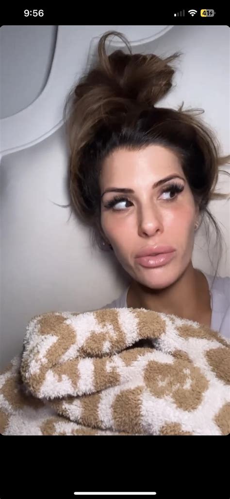 Bruised Overfilled Crooked Lumpy Lips R Emilyanngemmasnark