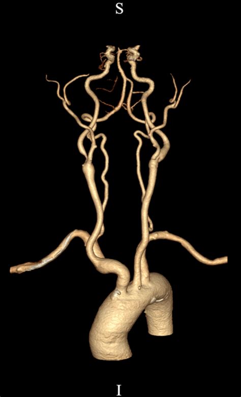 运用“egs”经桡技术治疗右侧颈动脉狭窄一例 脑医汇