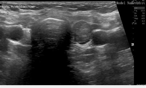 A Neck Ultrasound Scan Showing A Midline Exophytic Thyroid Nodule Download Scientific Diagram