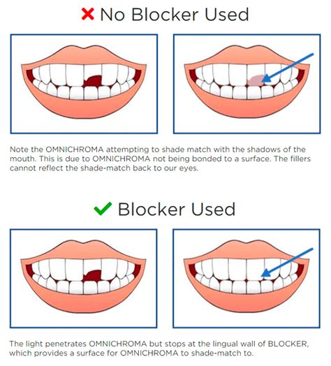 Omnichroma Blocker шприц 4 г Tokuyama Dental Реставраційний