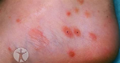 Prurigo Of Pregnancy Image