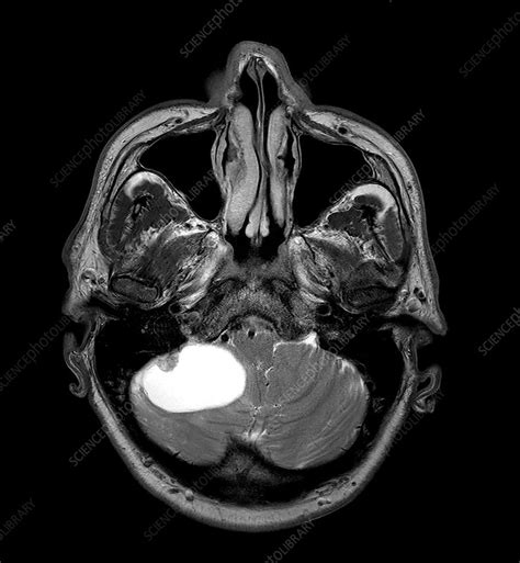 Cerebellar Hemangioblastoma Mri Stock Image C0433011 Science