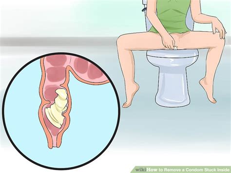 Ways To Remove A Condom Stuck Inside WikiHow