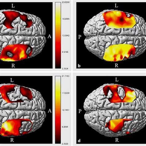 Pdf Low Frequency Rtms And Intensive Occupational Therapy Improve