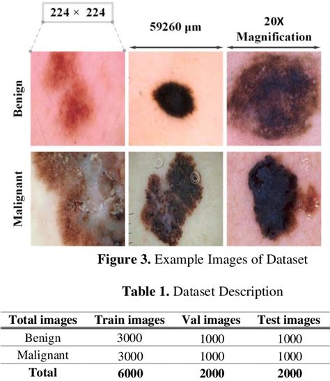 Figure 3 From Skin Cancer Segmentation And Classification Using Vision Transformer For Automatic