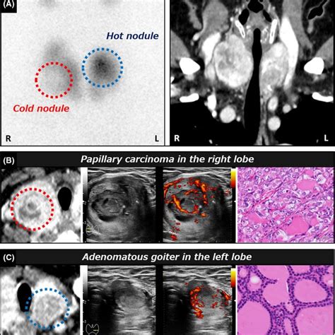 Pdf Simultaneous Hot And Cold Thyroid Nodules Which Is Malignant