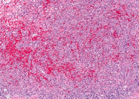 Kaposi Sarcoma Histology Classic Kaposis Sarcoma Presenting In The