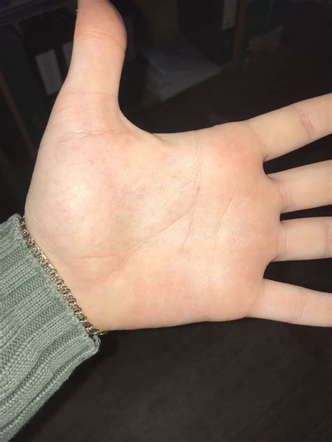 Белые пятна на ладонях M3rt Ers Ответы Mail