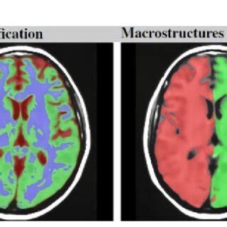 Images Presenting Highlighted Subcortical Structures As Occurred From Download Scientific