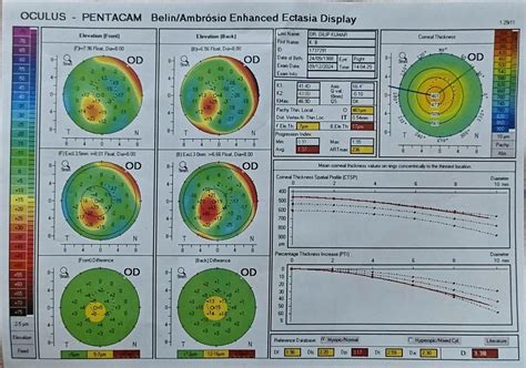 Corneal Topography In Detailed Explation Ppt