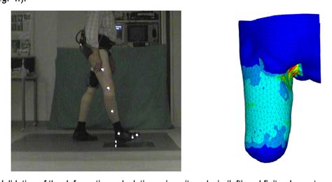 Table From Computer Assisted Optimization Of Prosthetic Socket Design For The Lower Limb